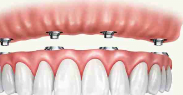 the all on 8 dental implants cost: A Comprehensive Guide to Your Smile ...