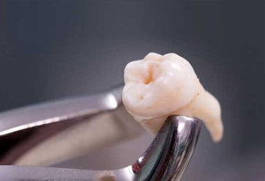 Shedding Light on Tooth Extraction Cost in Japan: A Comprehensive Guide