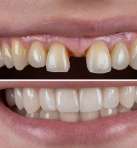 Unveiling the Smile: A Comprehensive Guide to Dental Bonding Cost in ...
