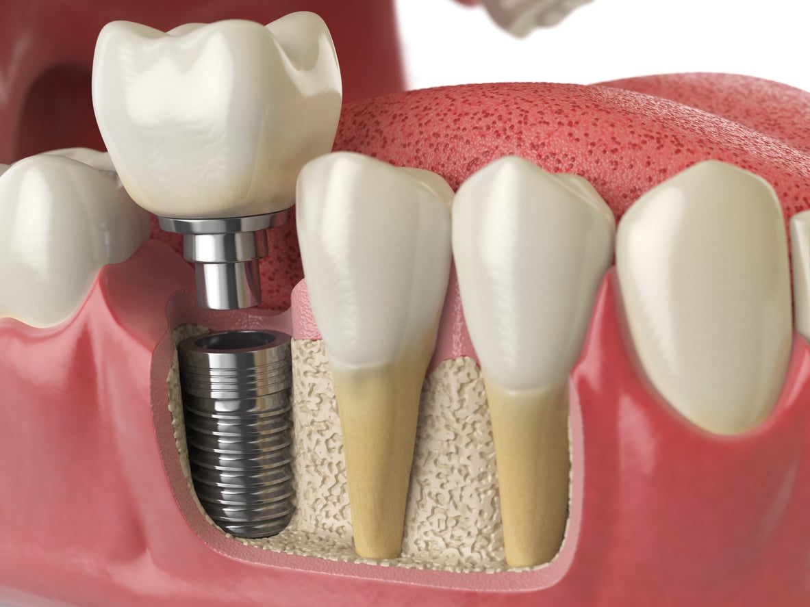 Tooth Extraction and Dental Implants